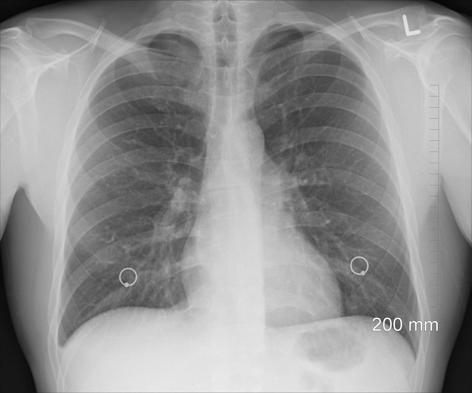 M42 announces breakthrough results for its AI-powered tuberculosis ...
